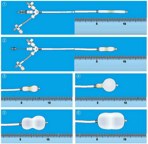 Percutaneous Therapies for Valvular Heart Disease | Thoracic Key