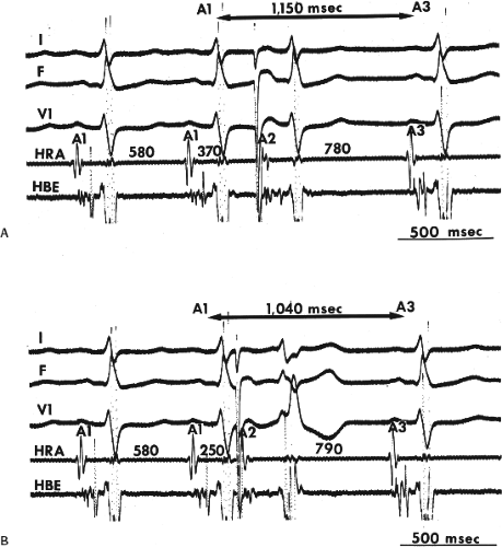 Sinus Node Function | Thoracic Key