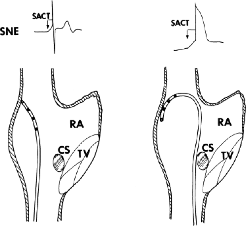 Sinus Node Function | Thoracic Key