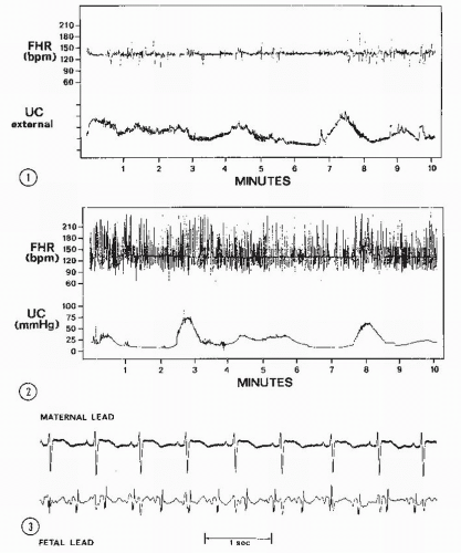 Instrumentation and Artifact Detection Including Fetal Arrhythmias ...
