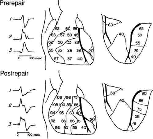 Intraventricular Conduction Disturbances | Thoracic Key