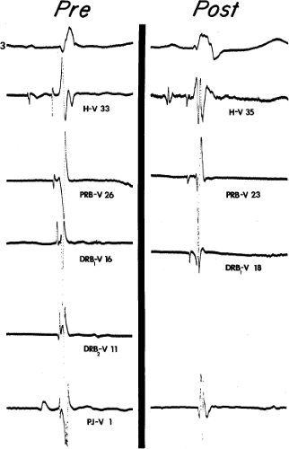Intraventricular Conduction Disturbances | Thoracic Key