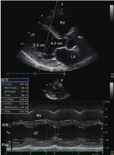 Evaluation of Systolic Function of the Left Ventricle | Thoracic Key