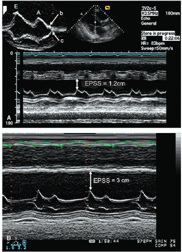 Evaluation of Systolic Function of the Left Ventricle | Thoracic Key
