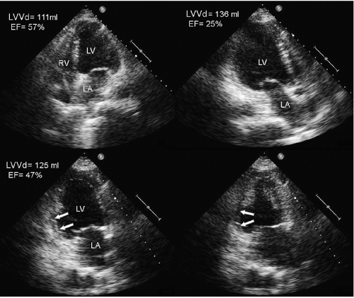 Evaluation of Systolic Function of the Left Ventricle | Thoracic Key