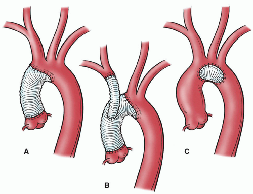 Arch Aneurysms | Thoracic Key