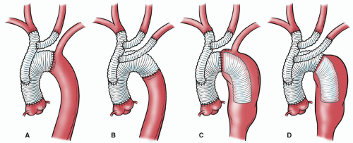 Arch Aneurysms | Thoracic Key