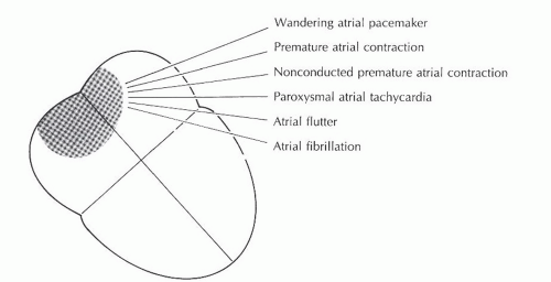 Atrial Arrhythmias | Thoracic Key