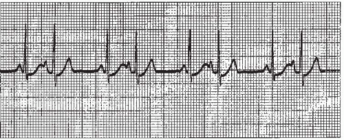 Atrial Arrhythmias | Thoracic Key