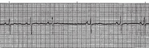 Atrial Arrhythmias | Thoracic Key