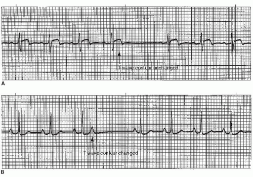 Atrial Arrhythmias | Thoracic Key