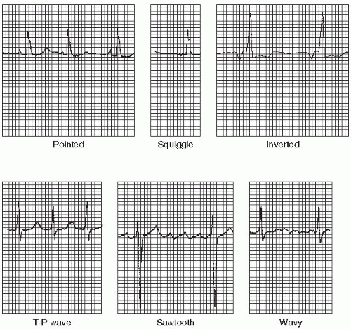 Atrial Arrhythmias | Thoracic Key