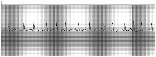 Atrial Arrhythmias | Thoracic Key