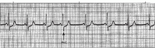 Atrial Arrhythmias | Thoracic Key