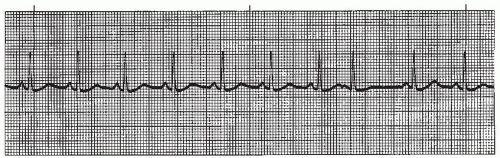 Atrial Arrhythmias | Thoracic Key