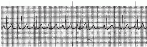 Atrial Arrhythmias | Thoracic Key