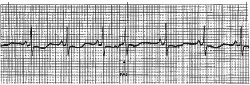 Atrial Arrhythmias | Thoracic Key
