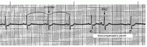 Atrial Arrhythmias | Thoracic Key