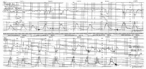 Clinical Management of Abnormal Fetal Heart Rate Patterns | Thoracic Key