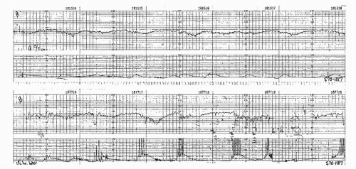 Clinical Management of Abnormal Fetal Heart Rate Patterns | Thoracic Key