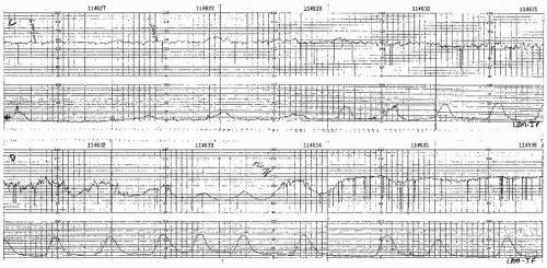 Clinical Management of Abnormal Fetal Heart Rate Patterns | Thoracic Key