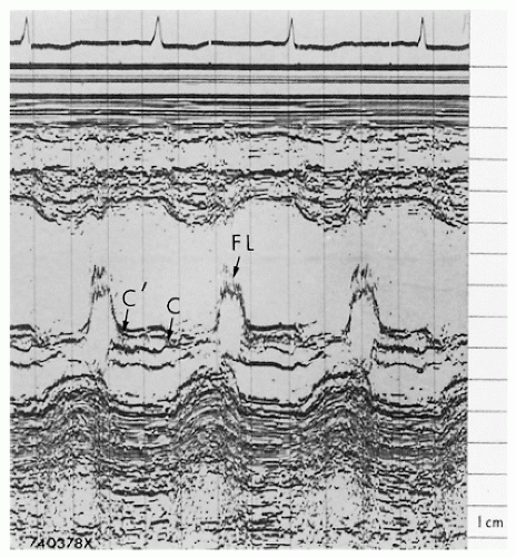 Hemodynamics | Thoracic Key