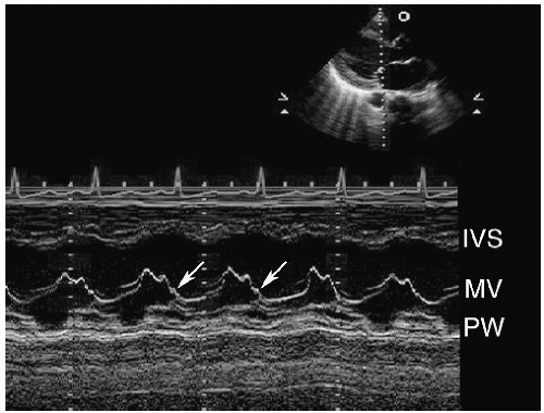 Hemodynamics | Thoracic Key