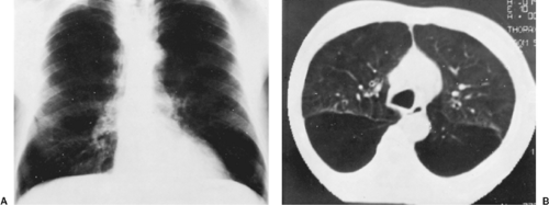 Bullous and Bleb Diseases of the Lung | Thoracic Key