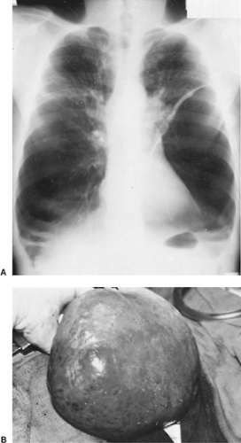 Bullous and Bleb Diseases of the Lung | Thoracic Key