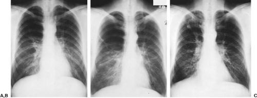 Bullous and Bleb Diseases of the Lung | Thoracic Key