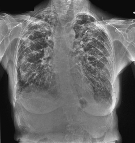 Diffuse Lung Disease | Thoracic Key