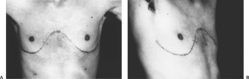 Secondary Tumors of the Lung | Thoracic Key