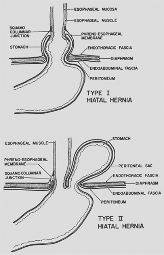 Paraesophageal Hiatal Hernia | Thoracic Key