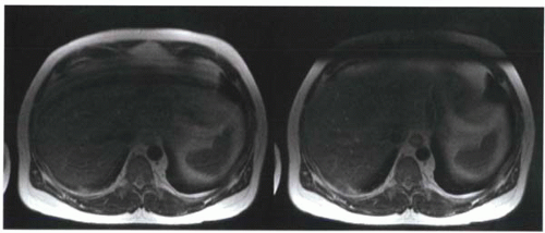 Black-Blood Imaging | Thoracic Key