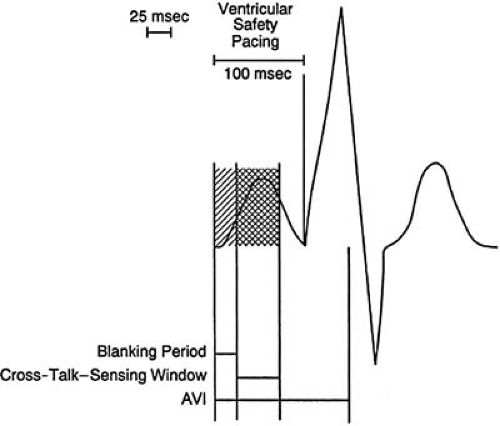 Cardiac Pacemakers | Thoracic Key