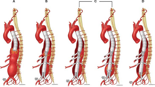 TEVAR for Thoracoabdominal Aneurysm Repair | Thoracic Key