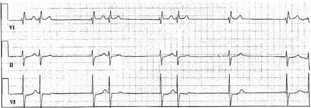 1: Indications for Permanent and Temporary Cardiac Pacing | Thoracic Key