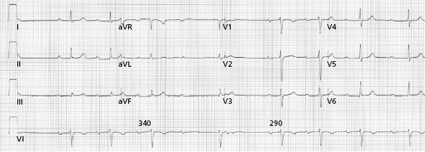 1: Indications for Permanent and Temporary Cardiac Pacing | Thoracic Key
