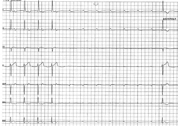 1: Indications for Permanent and Temporary Cardiac Pacing | Thoracic Key