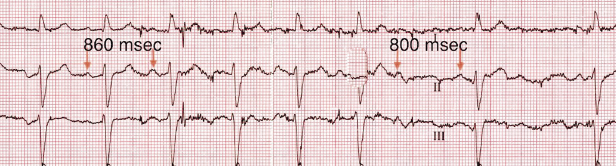 1: Indications for Permanent and Temporary Cardiac Pacing | Thoracic Key