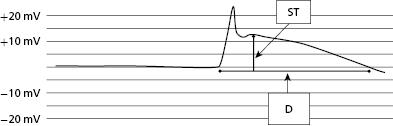 2: Components of a Pacing and ICD System: Basic Concepts of Pacing ...