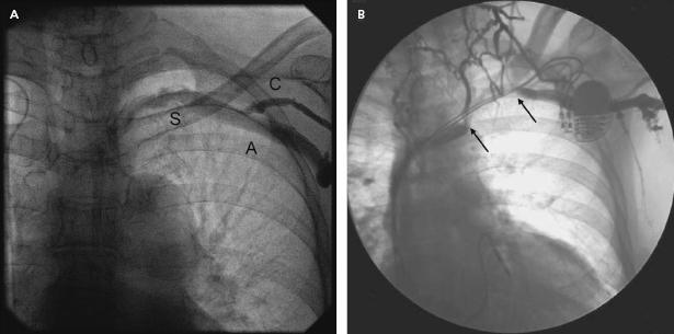 5: Techniques of Pacemaker Implantation and Removal | Thoracic Key