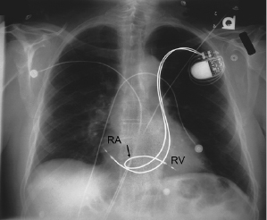 5: Techniques of Pacemaker Implantation and Removal | Thoracic Key