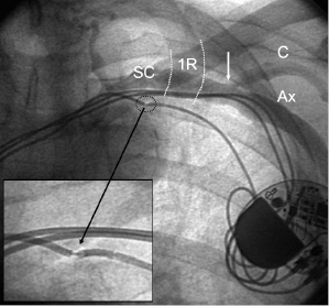 5: Techniques of Pacemaker Implantation and Removal | Thoracic Key