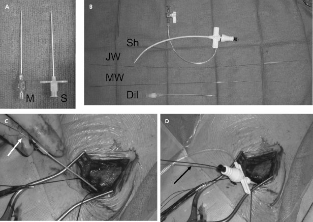 5: Techniques of Pacemaker Implantation and Removal | Thoracic Key