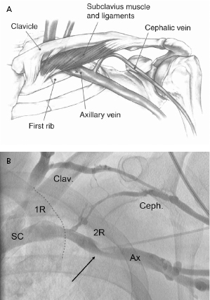5: Techniques of Pacemaker Implantation and Removal | Thoracic Key