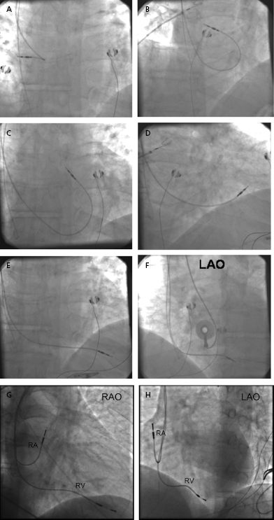 5: Techniques of Pacemaker Implantation and Removal | Thoracic Key