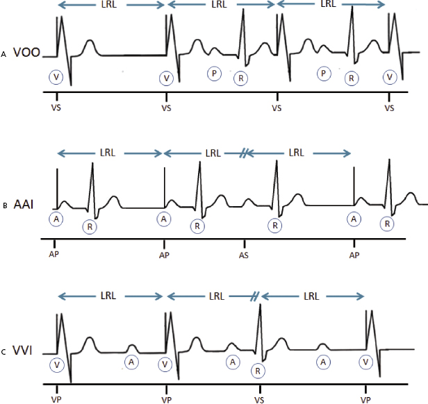 6: Pacemaker Timing Cycles and Special Features | Thoracic Key