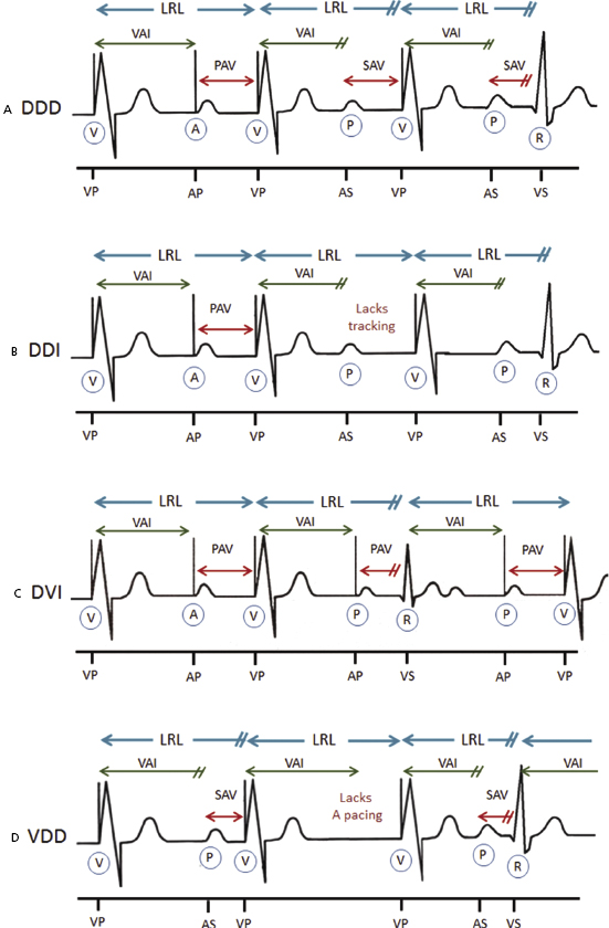 6: Pacemaker Timing Cycles and Special Features | Thoracic Key