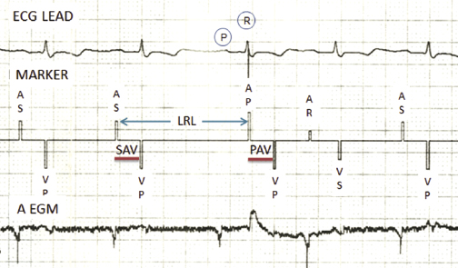 6: Pacemaker Timing Cycles and Special Features | Thoracic Key
